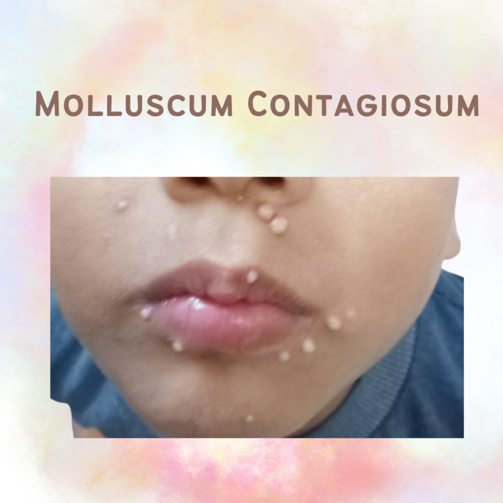 Homeopathic Treatment for Molluscum Contagiosum – Caitanya Healing by ...
