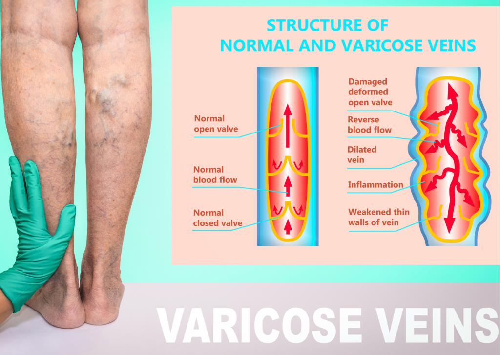 Understanding Varicose Veins and What to Do About Them – Caitanya ...